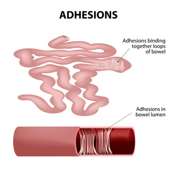 Hysterectomy Pain & Adhesions | Horizon Physical Therapy and Rehabilitation